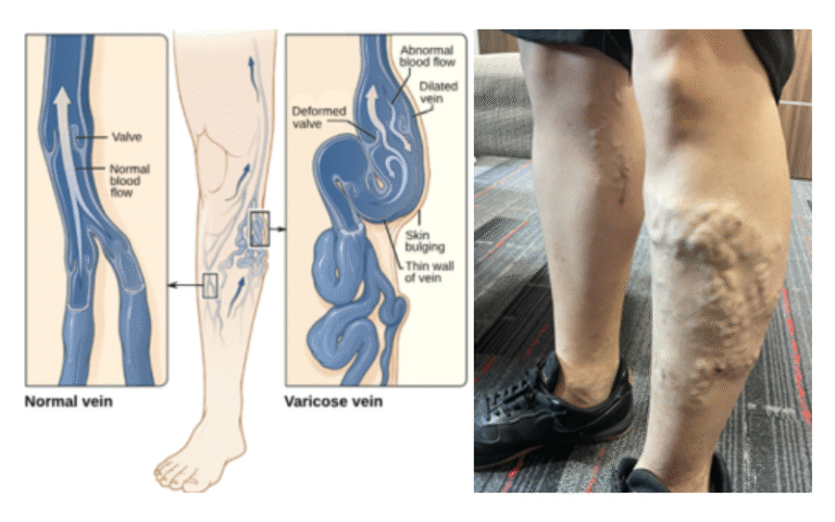Varicose Veins Treatment Singapore | Dr. Darryl Lim
