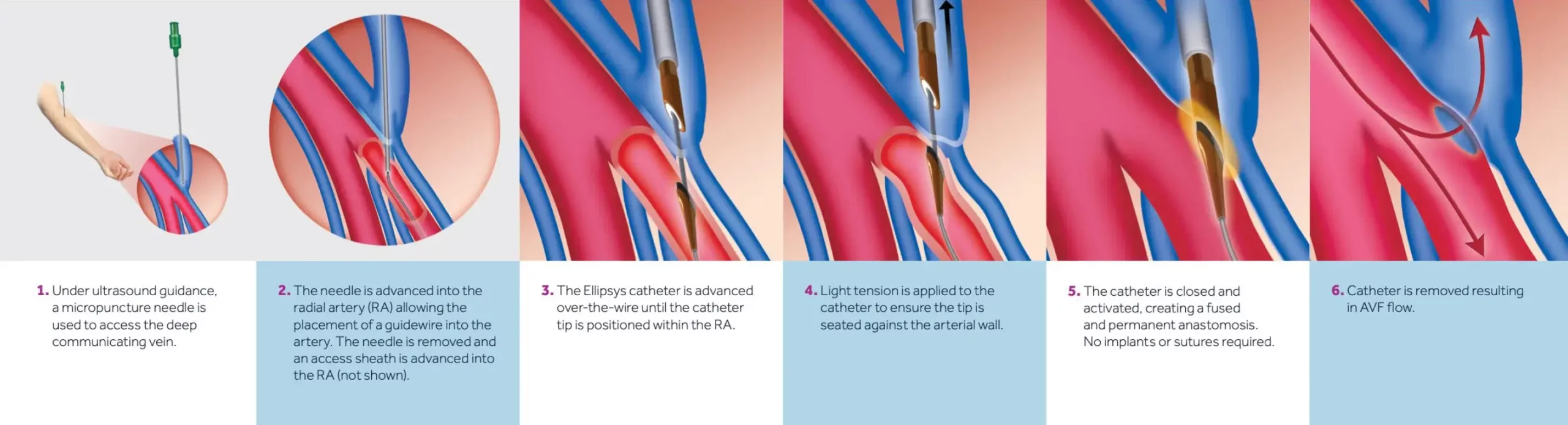 Endovascular AVF Creation Services Singapore | Dr Darryl Lim