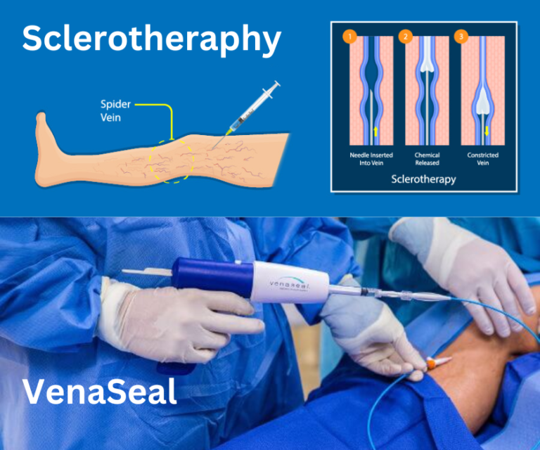 Comparing Sclerotherapy and Venaseal | Dr. Darryl Lim