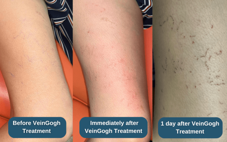 Exploring the Effect: My Spider Veins Look Worse After Treatment