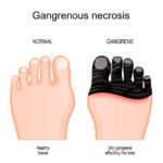 Understanding Gangrene Toe Symptoms: Causes and Treatment