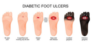 Early Stage Diabetic Foot Ulcer: Prevention and Treatment