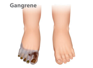 Why Are My Toes Turning Black? Causes and Symptoms Explained