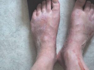 Causes of Dark Spots on Legs: Understanding the Factors